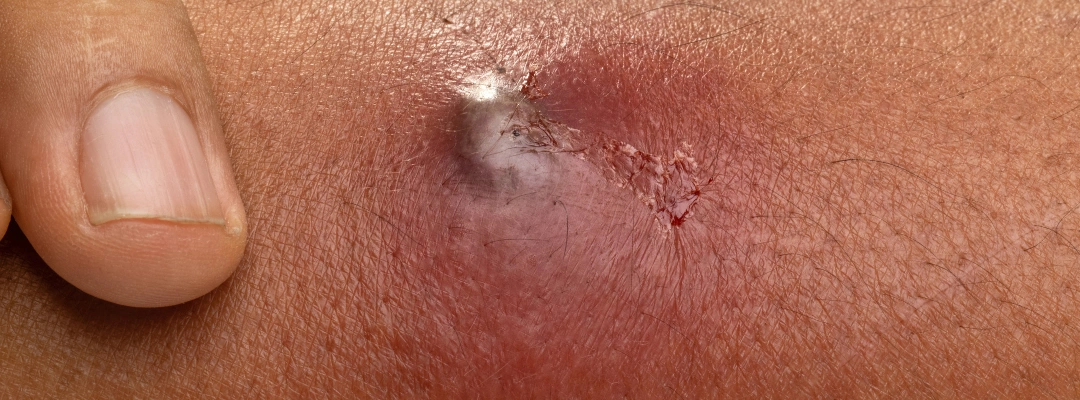 Addressing an Abscess from Shooting Drugs | Find Support