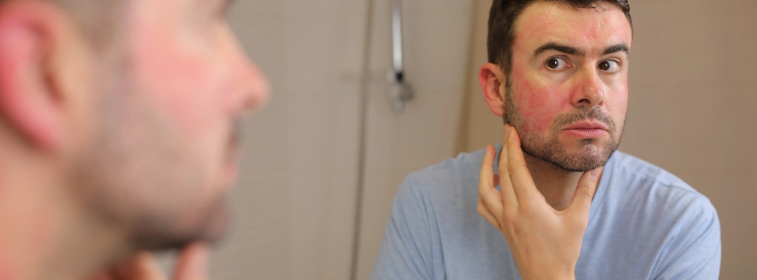 How to Treat A Skin Rash from Alcohol Abuse | Find Support