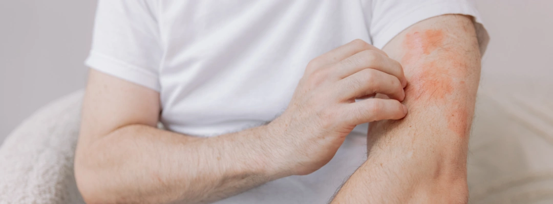 How to Treat A Skin Rash from Alcohol Abuse | Find Support