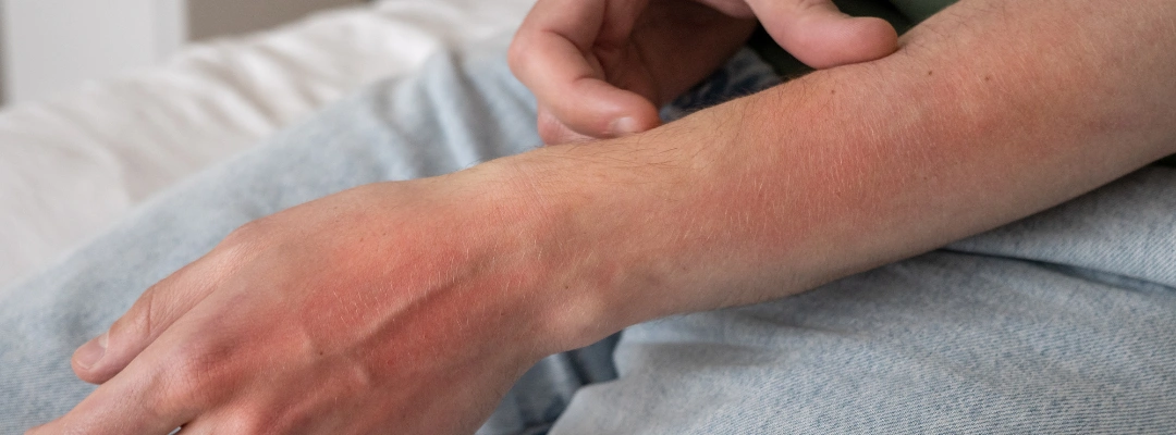 How to Treat A Skin Rash from Alcohol Abuse | Find Support