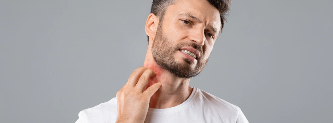How to Treat A Skin Rash from Alcohol Abuse | Find Support